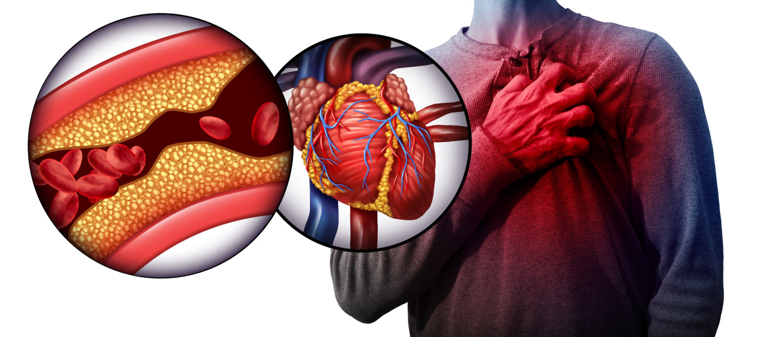 What is a Widowmaker Heart Attack? - Showit Blog
