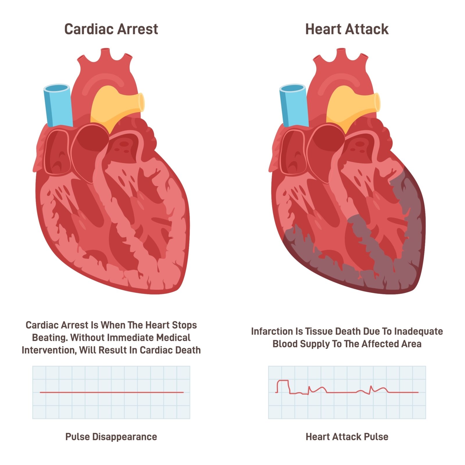 Cardiac Arrest vs. Heart Attack: What’s the Difference? - Showit Blog