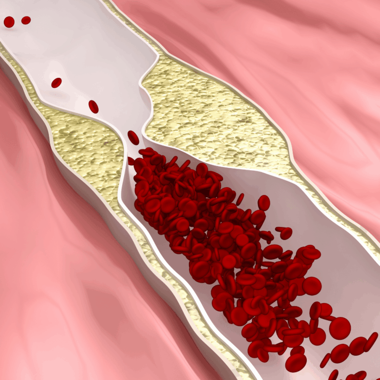 What Causes Plaque in Arteries?
